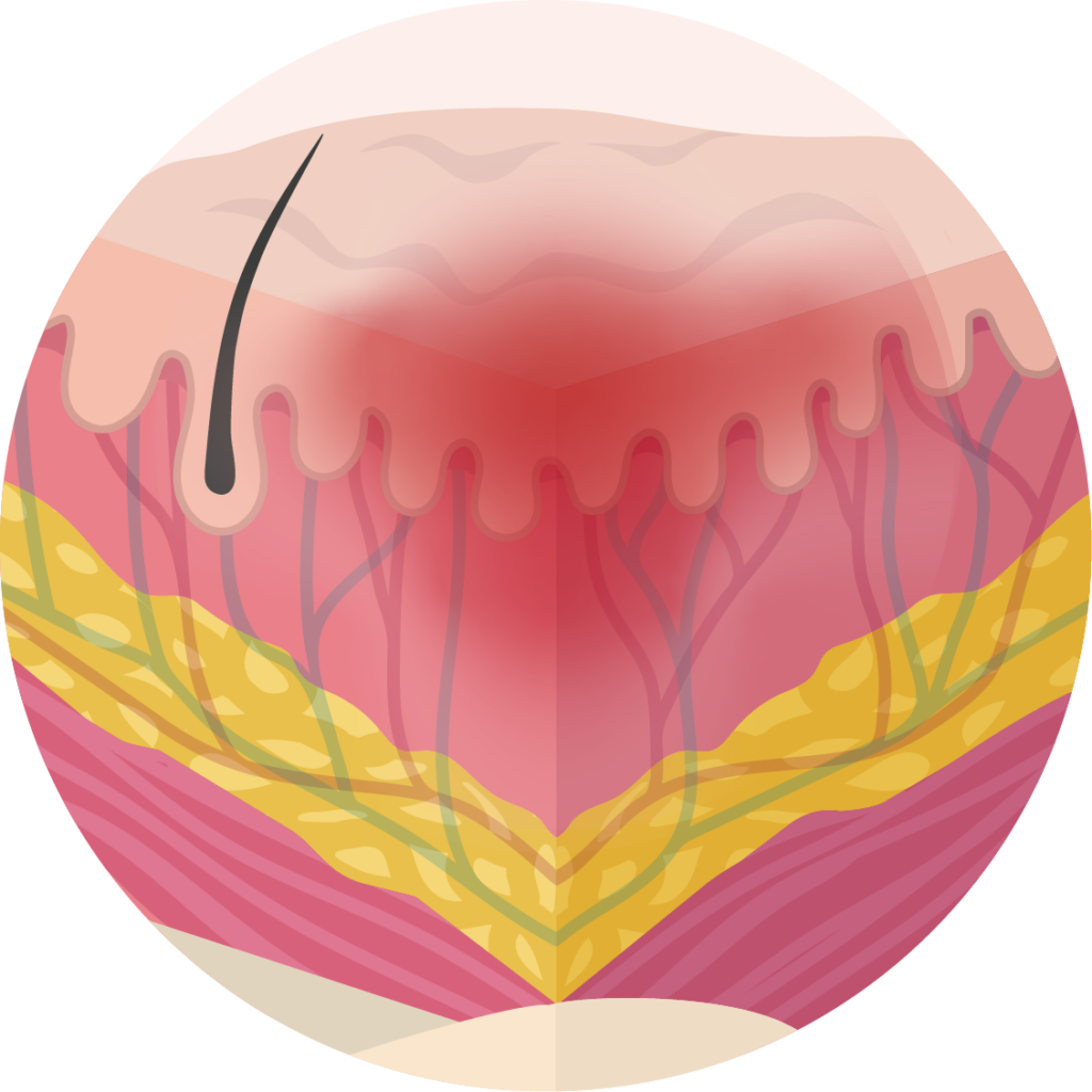 Richtlijn Decubitus - Kennisplatform V&VN