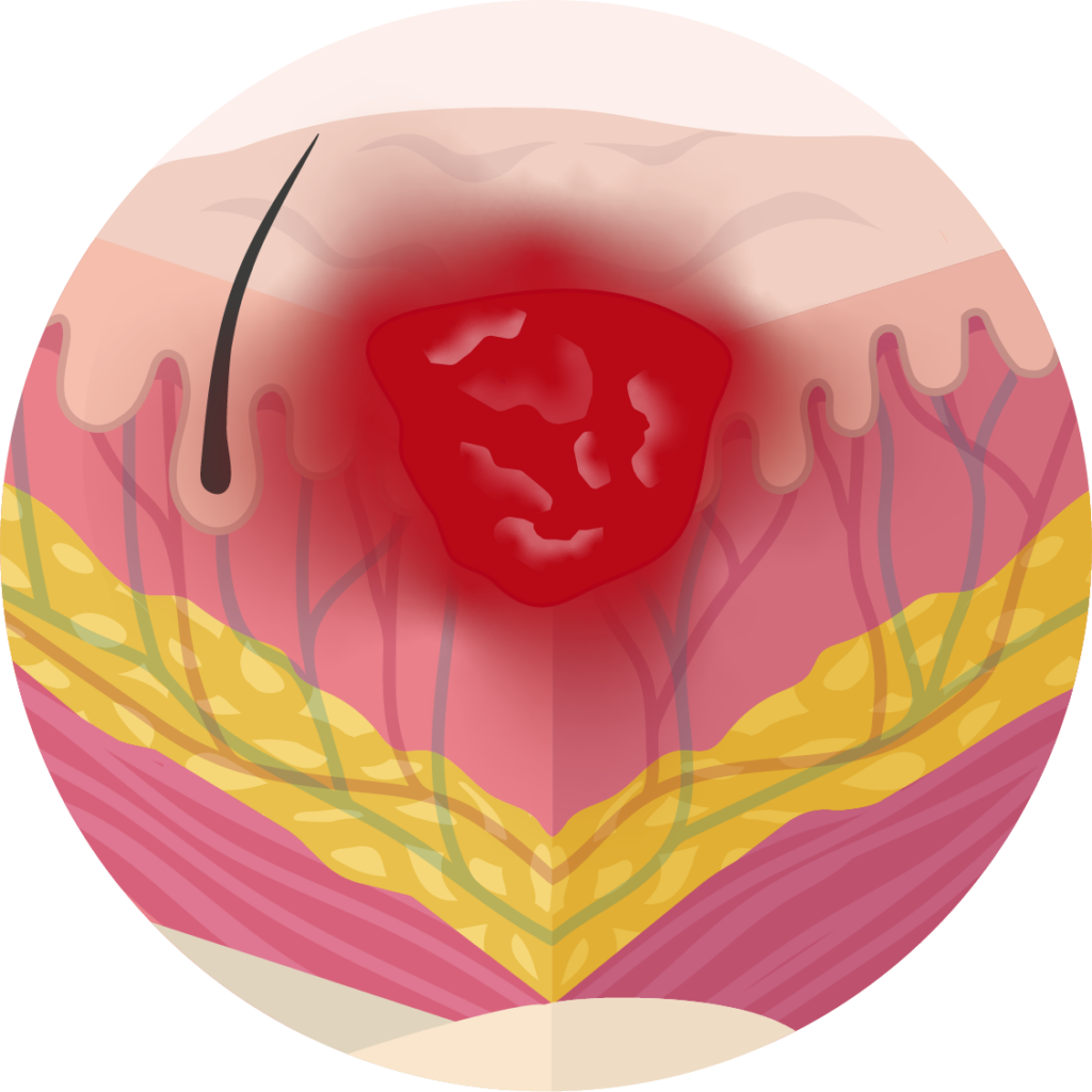 Richtlijn Decubitus - Kennisplatform V&VN