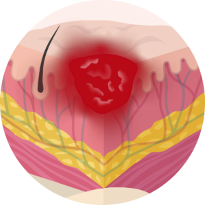 Richtlijn Decubitus - Kennisplatform V&VN