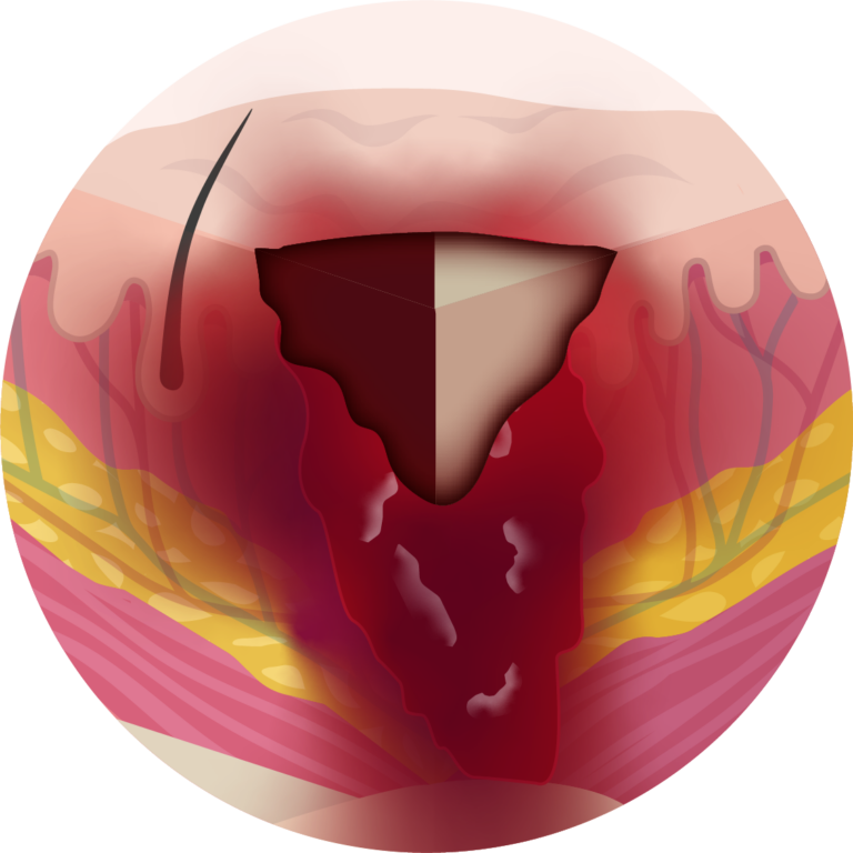 Richtlijn Decubitus - Kennisplatform V&VN